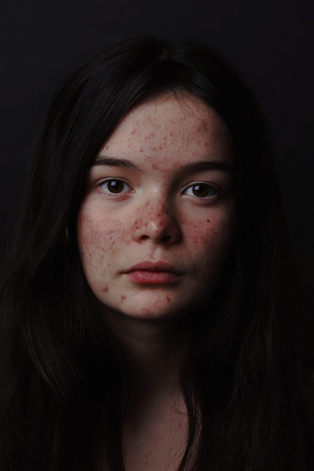 A Complete Guide to Adult Acne - Skinsmart | Dermatologist recommended ...